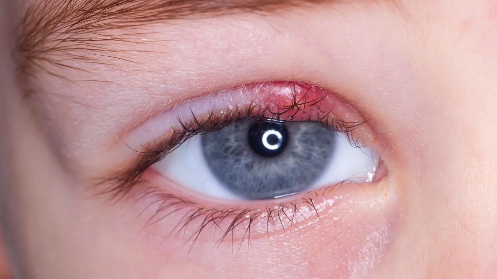 Gerstenkorn bei Kindern: Ursachen, Symptome und Therapie